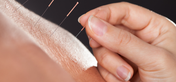 How much does acupuncture cost in Australia? | NaturalTherapyPages.com.au